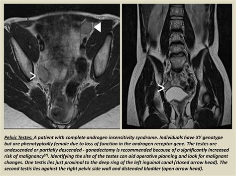 Presentation1 Radiological Imaging Of Undescended Testis Pptx