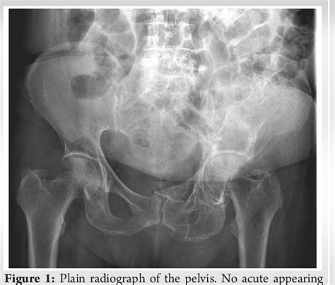 Pdf Delayed Presentation Of Sciatic Nerve Palsy Due To Post Traumatic