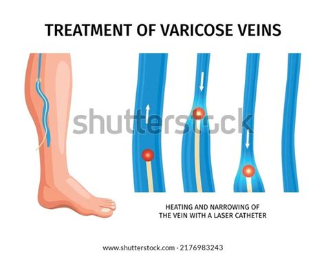 Varicose Veins Laser Over 207 Royalty Free Licensable Stock