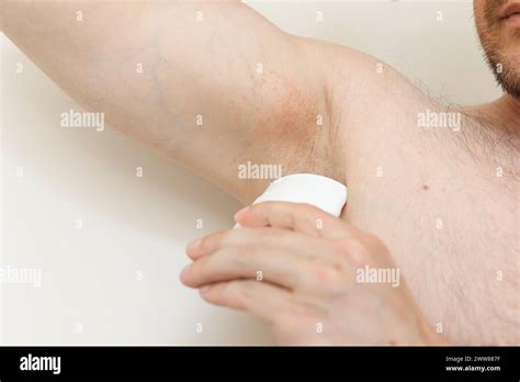 Young Man With Irritation Inflammation On Sensitive Underarm Skin Using Deodorant Or