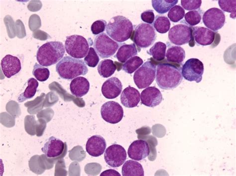 Aml With Mutated Npm1