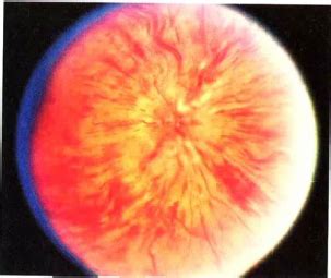 NEURO Diseases Of Vision Flashcards Quizlet