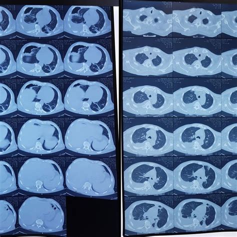 Figure No 5 Chest CT Scan Figure No 6 Chest CT Scan After The Download Scientific Diagram