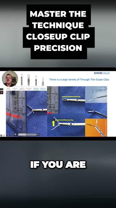 Endocollab™ Gi Endoscopy Education On Linkedin Endoscopy