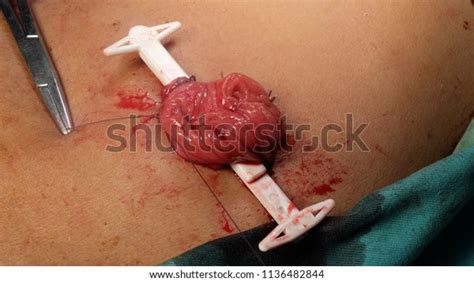 Diversion Loop Colostomy Royalty Free Images Stock Photos Pictures Shutterstock