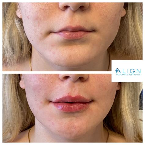 Versa Lip Filler Lip Fillers Lips Versa