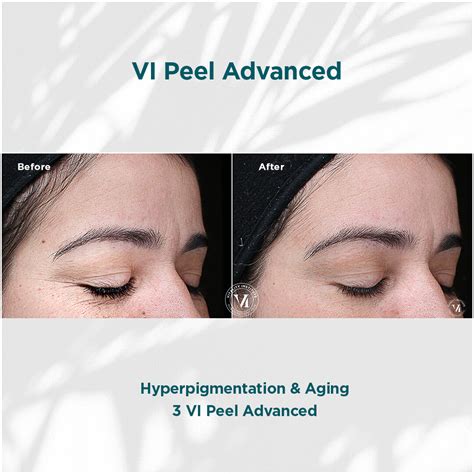 Vi Chemical Peel Morristown Nj Trusted Physician Owned