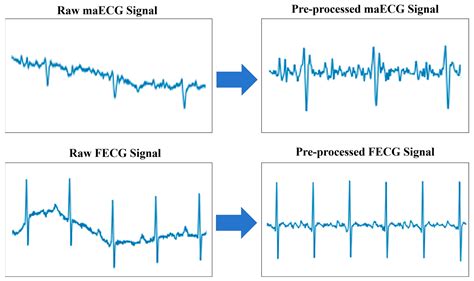 Fetal Ecg Signal Extraction From Maternal Abdominal Ecg Signals Using