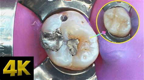 Incrível Dentista Usa Toda Sua Habilidade Para Trocar Restauração