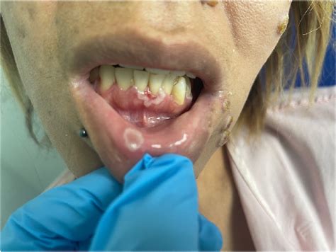 Herpes Simplex Virus Ii Coinfection With Mpox In The Lower Lip Of A