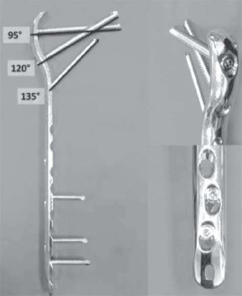 The Locking Compression Plate For The Proximal Femur Is A Precontoured