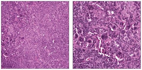 Ductal Adenocarcinoma Including Variants Basicmedical Key