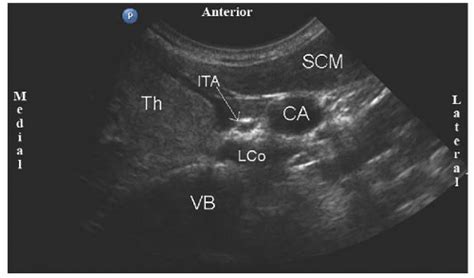 Ultrasound Guided Cervical Sympathetic Block Anesthesia Key