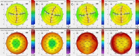 Ten Year Outcomes After Initial Management With Laser Photocoagulation