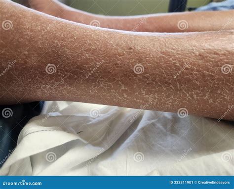 Pembroliimab Rash With Edema And Desquamation Cancer Patient Stock Image Image Of Melanoma