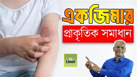 🌿 একজিমা Eczema।এ্যাটোপিক ডার্মাটাইটিস এবং বিখাউজ এর কারণ।লক্ষণ ও