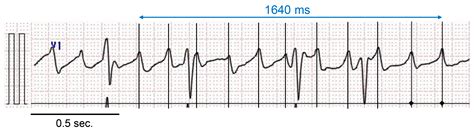 Predictors Of Recurrence After Catheter Ablation Of Paroxysmal Atrial Fibrillation In Different