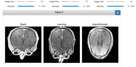 3d Registration Of Anatomical And Functional Mri Of Brain Images