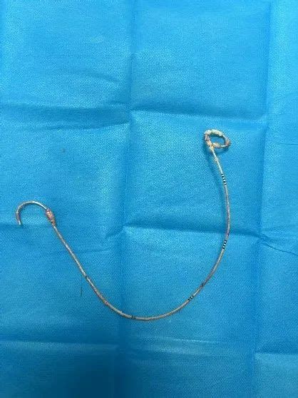 青大附院成功完成两例经体外碎石的输尿管支架拔除术 青海大学附属医院