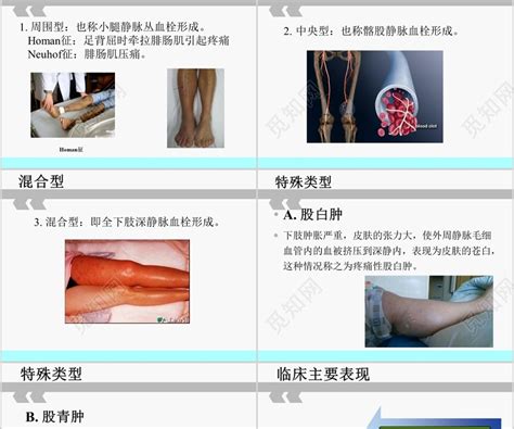 灰色简约经典医学医疗下肢静脉血栓的护理查房ppt下载 觅知网