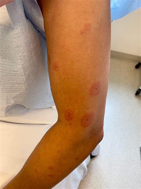 Erythematous Edematous Plaques On Face And Extremities Clinical Advisor