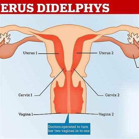 Intimate Empire Pictures Of How Uterus Didelphys 2