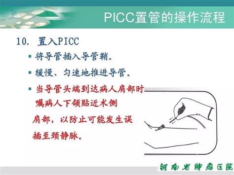 经外周置入中心静脉导管 搜狐