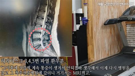 허리디스크 파열 터짐 증상 디스크가 터지면파열 꼭 수술해야 할까요 산타재활운동 후기 네이버 블로그