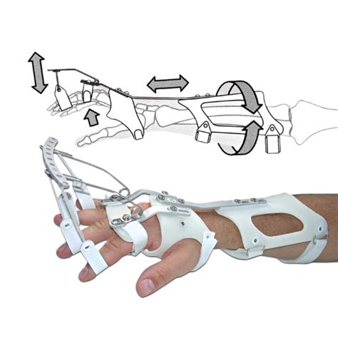 Dynamic Extention Wrisr Hand Splint Daho21 Pes Planus