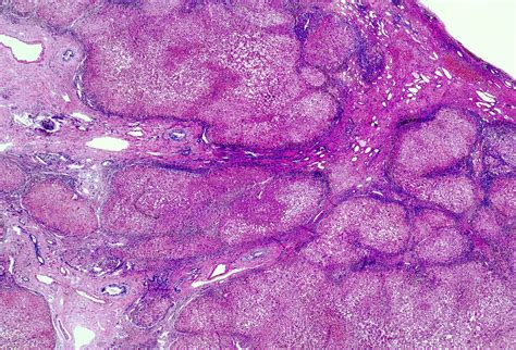 Alcoholic Hepatitis Light Micrograph Stock Image C0488578