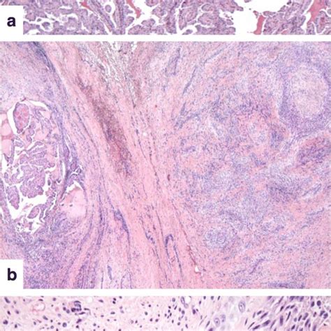 Anaplastic Spindle Cell Squamous Carcinoma Arising In A Background Of