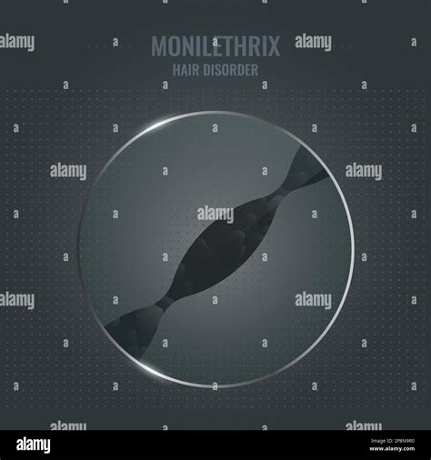 Beaded Hair Monilethrix At Milla Stelzer Blog