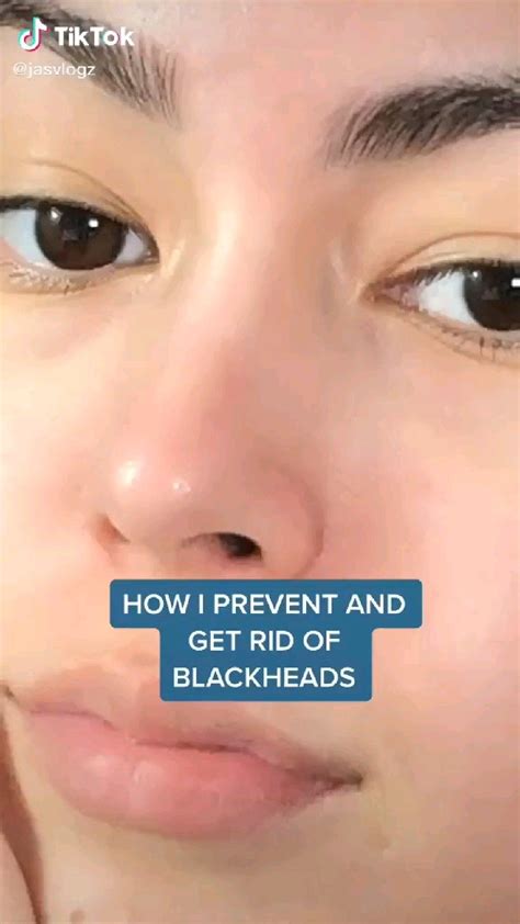 How To Get Rid Of Blackheads Naturally Artofit