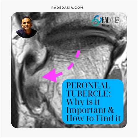 Peroneal Tubercle Radedasia Radiology Education Asia Facebook