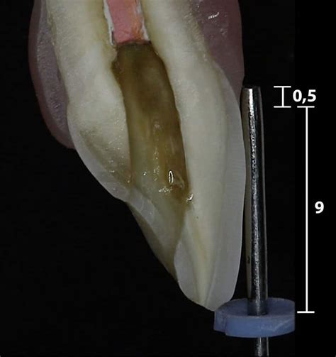 Clareamento interno em dentes tratados endodonticamente Leonardo Muniz Estética do sorriso