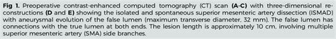 Preoperative Contrast Enhanced Computed Tomography Ct Scan A C With