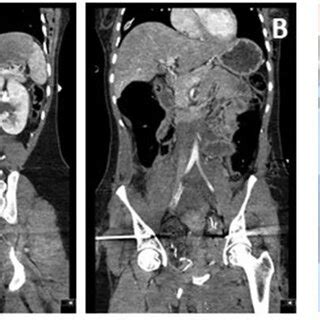 Case Of A Patient With A Hemodynamically Unstable Pelvic Fracture A