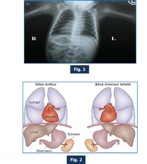 Figure 1 From Dextrocardia With Situs Inversus Totalis In Neonate