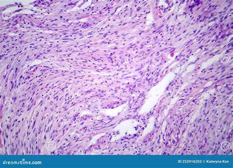 Meningioma Light Micrograph Photo Under Microscope Stock Image 253916203