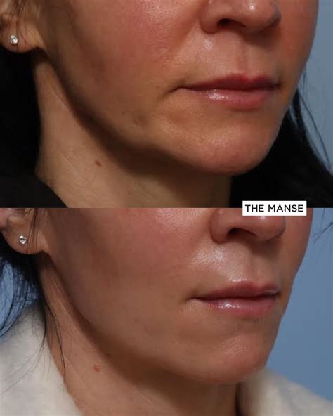 12 Overfilled Nasolabial Folds Jameyellarose