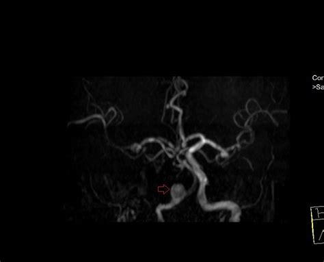 Cerebral Aneurysm Berry Aneurysms Mri Radiology Article On Saccular Aneurysm