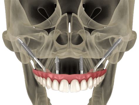 Zygomatic Dental Implants In Chicago Advanced Solutions