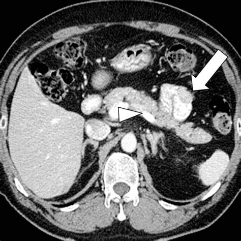 Incidentally Detected Heterotopic Pancreas Mimicking Small Bowel