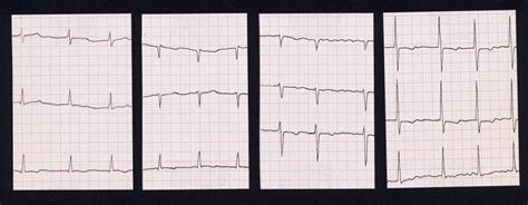After Intravenous Administration Of 100 Mg Lidocaine Monomorhic Download Scientific Diagram