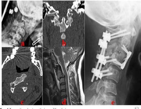 Figure 1 From Hangmans Fracture With Concomitant Atlantoaxial