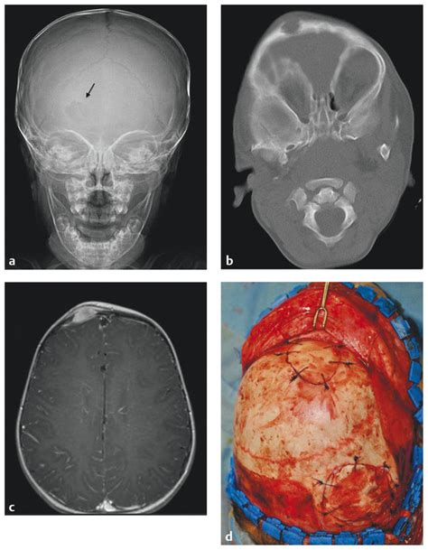 Scalp And Skull Neoplasms Neupsy Key