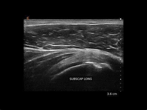 Subscap Tendon Long Clarius