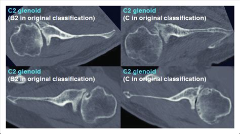 Ct Scan Examples Of 4 C2 Glenoids And Classification According To