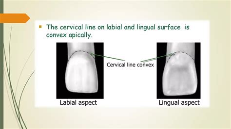 Maxillary Central Incisor Oral Anatomy Pptx