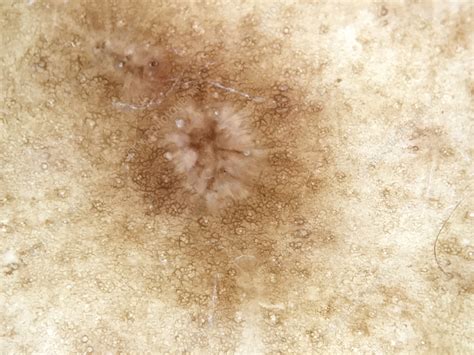 Dermatofibroma Dermoscopy Stock Image C0611534 Science Photo